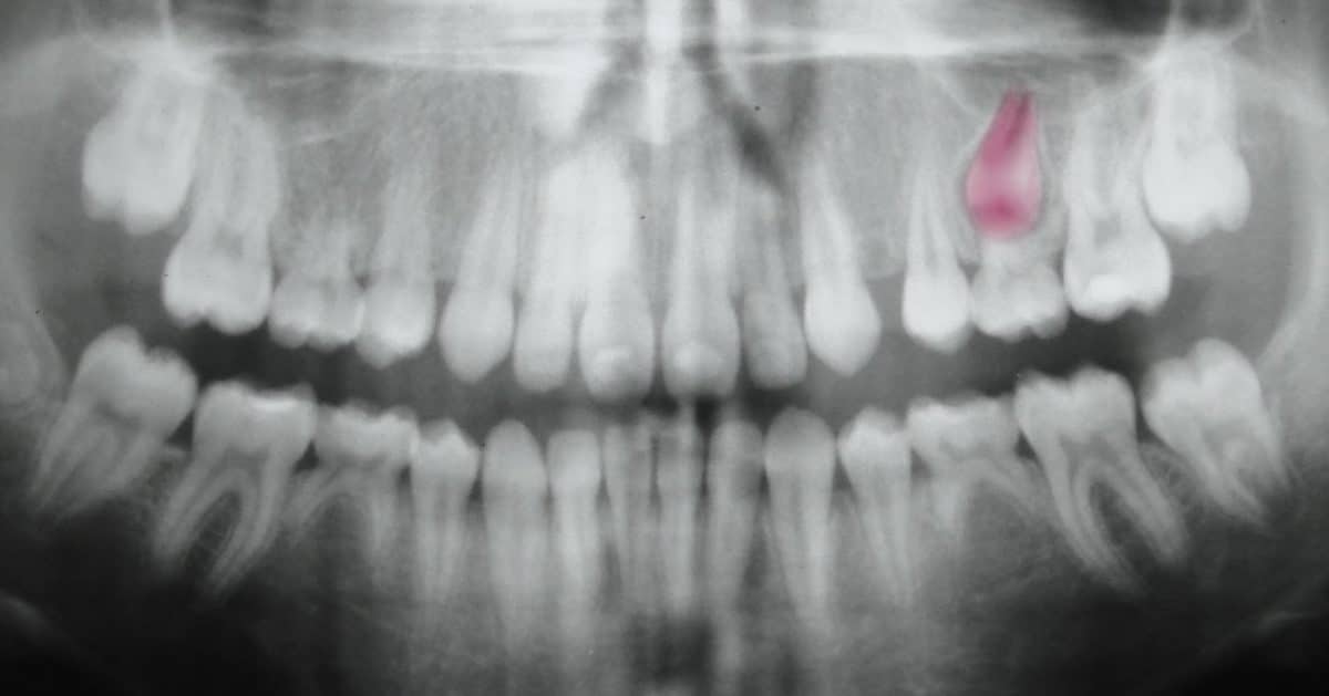 Extração Simples, extração de siso, extração de inclusos- Odontocenter